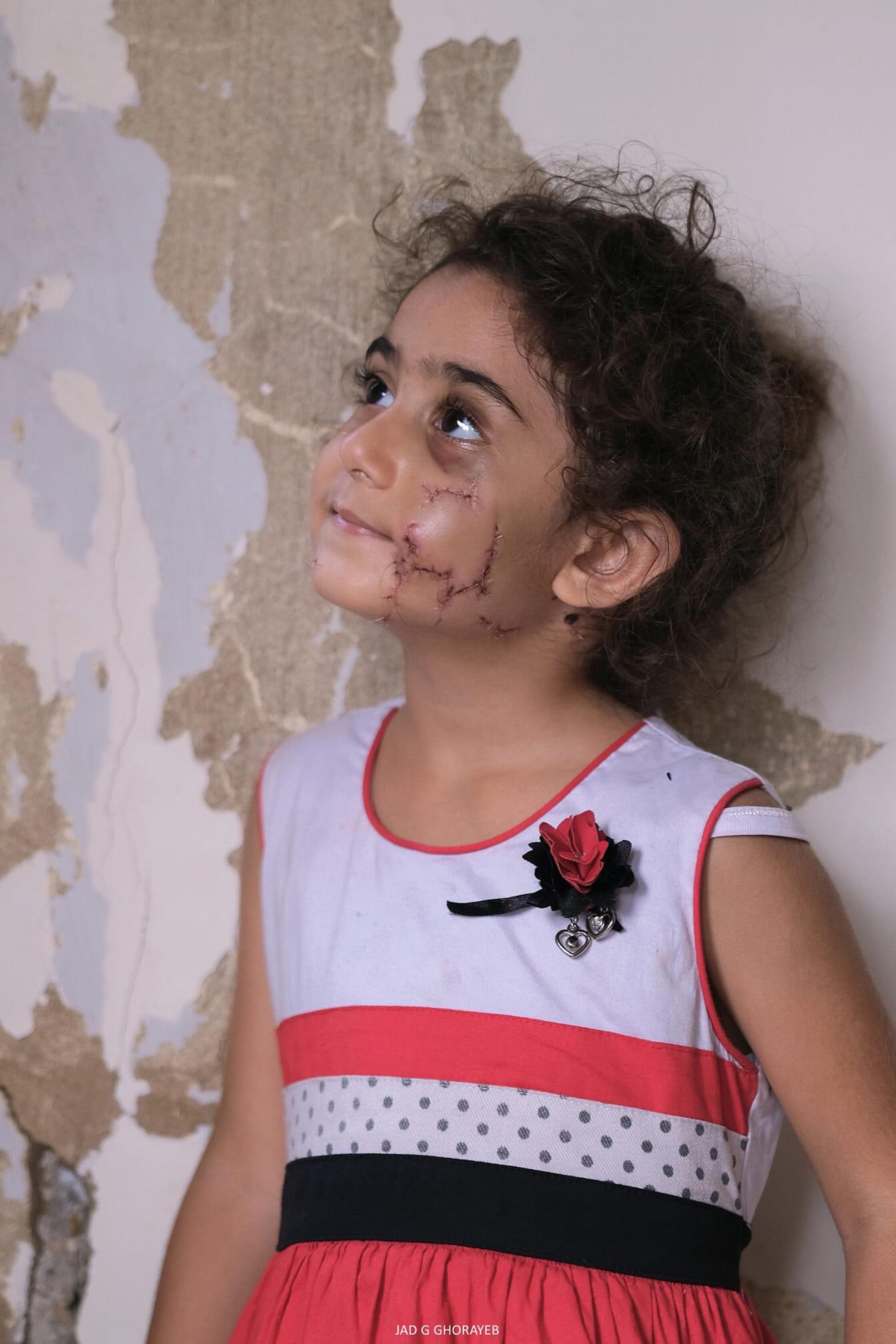 Lebanese Lifelong Scars: A Reminder of Beirut's Blast | Al Bawaba