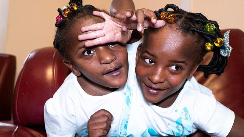 Story of the conjoined twins who weren't expected to live | Al Bawaba