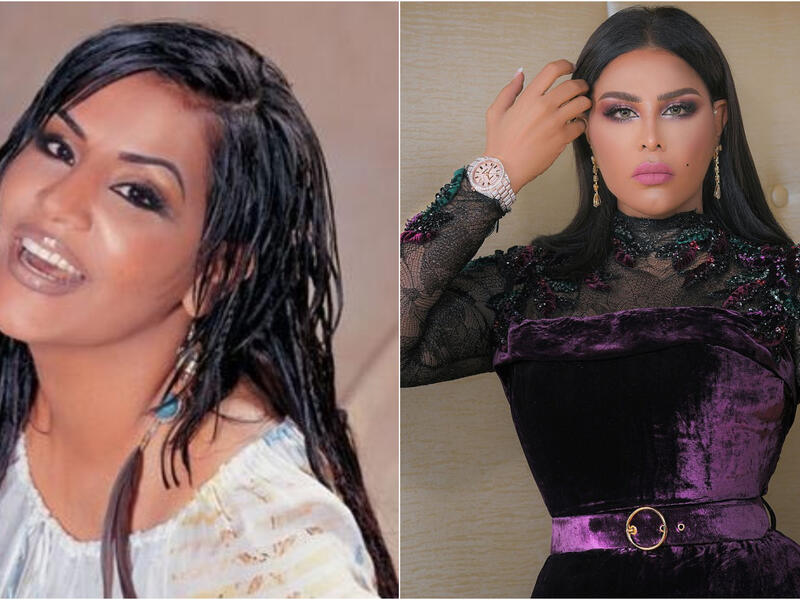 Shocking Before and After Shots for Arab Celebrities Underwent Jaw ...