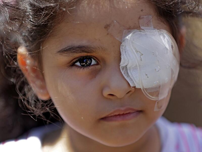 Lebanese Lifelong Scars: A Reminder of Beirut's Blast | Al Bawaba