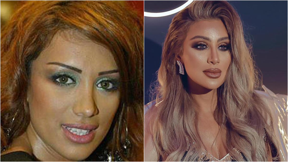 Shocking Before and After Shots for Arab Celebrities Underwent Jaw ...