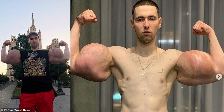 3Ib of Dead Muscle Removed From 'Popeye' Bodybuilder's Arms. Look How ...