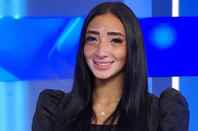 Egyptian Social Media Influencer With Vitiligo Finally Becomes TV ...