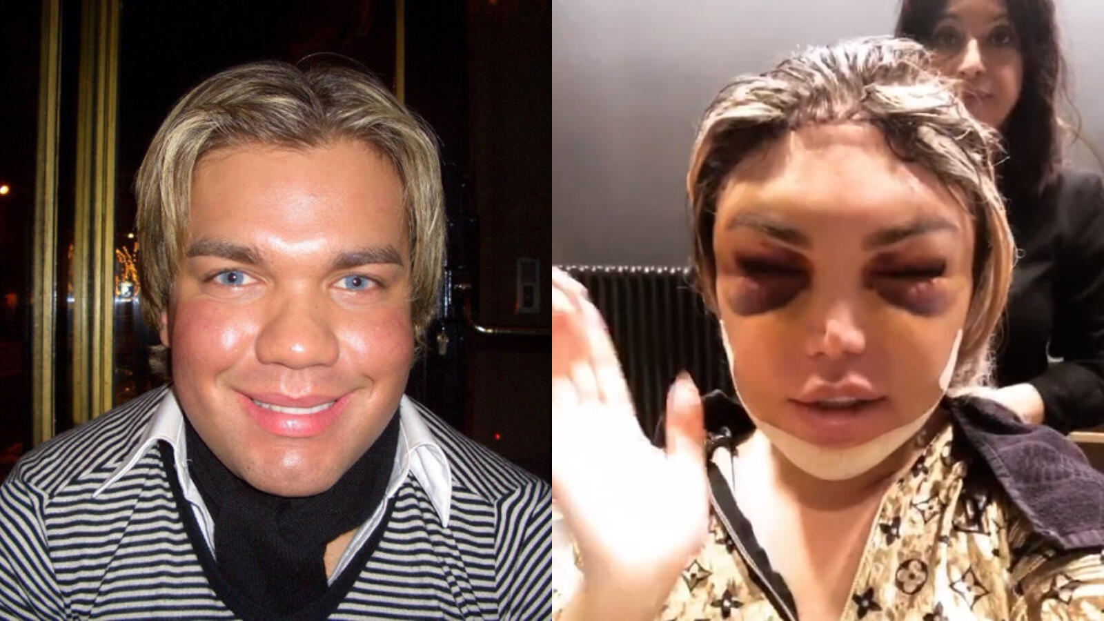 Roddy Alves Sporting a Very Bruised and Bandaged Face After Undergoing ...