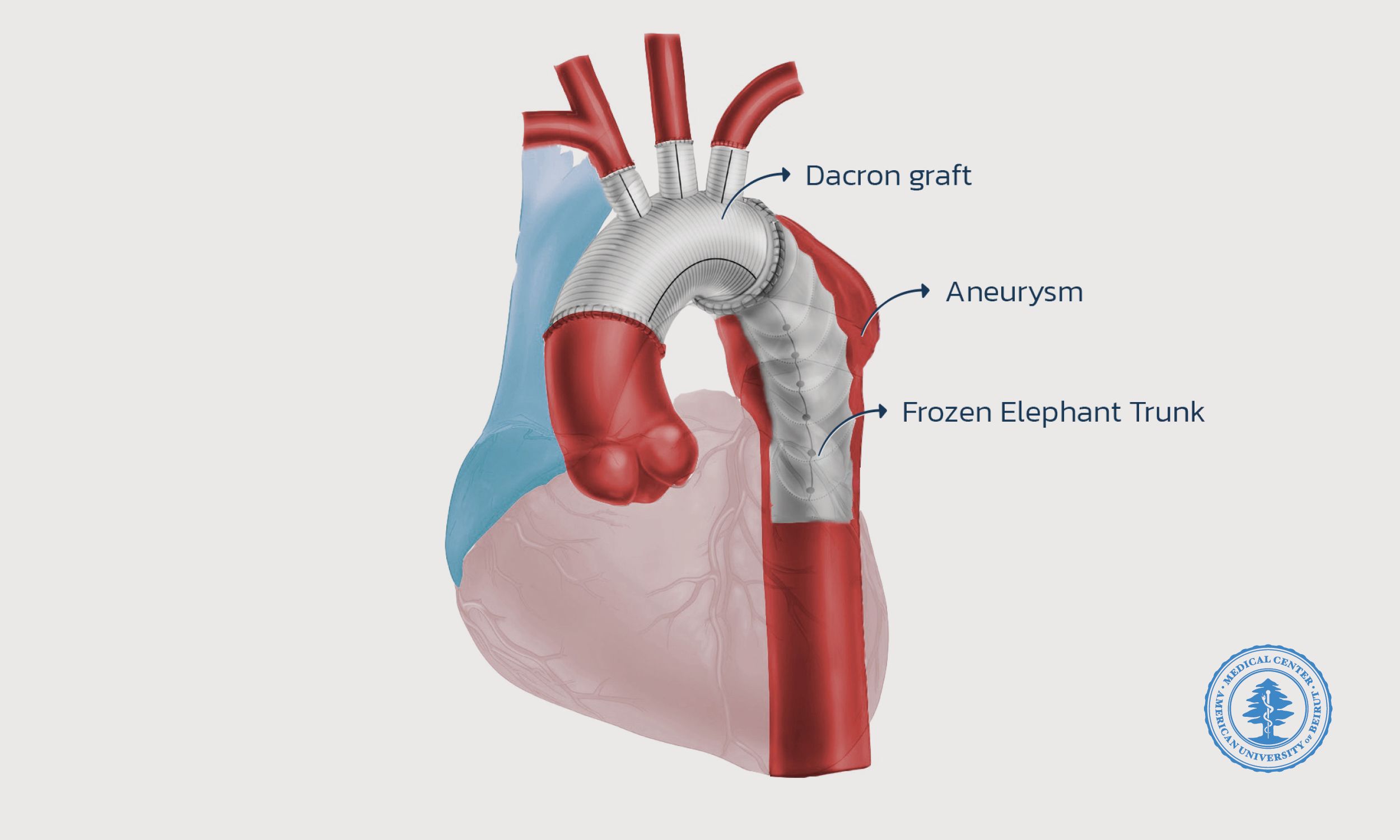 Breakthrough in Cardiac Surgery: AUBMC Performs the First Successful ...