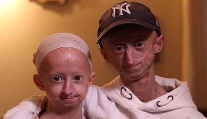 Belgium Brother, Sister Battle Incredibly Rare 'Benjamin Button Disease ...